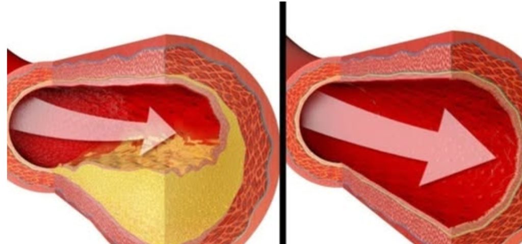 Only One Glass of This Juice… Reverse Clogged Arteries & Lower High ...